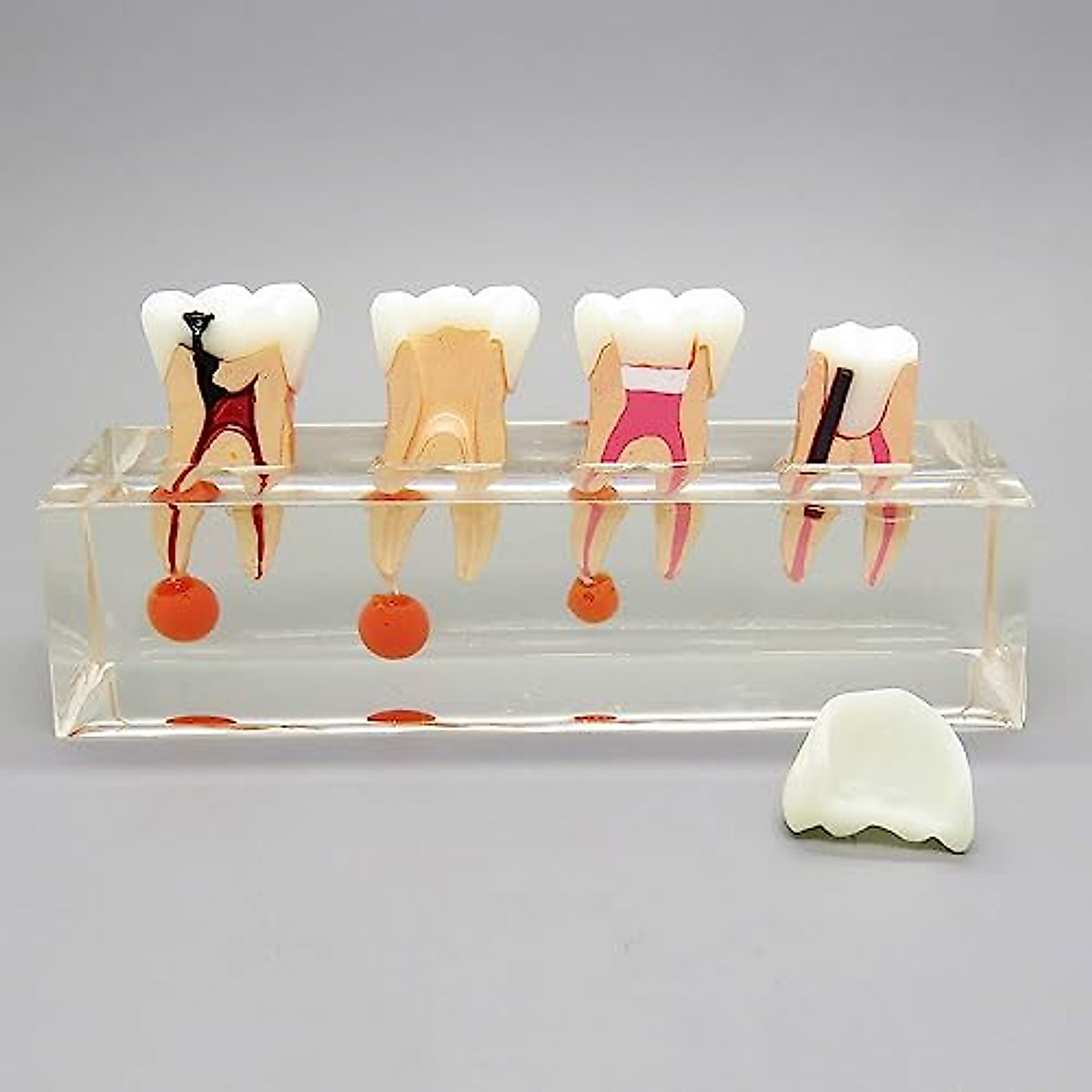 Dentalmall Dental 4-Stage Endodontic Treatment Model for Study Teach Teeth Model 4018 Root Canal Anatomy Demonstration Teaching Tooth Model