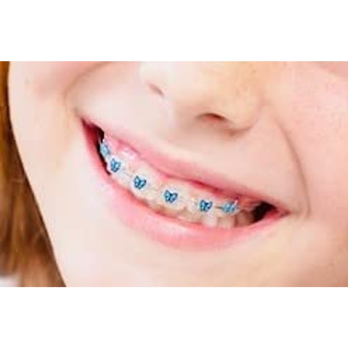 Snapcaps Braces Bumper Cover, Orthodontic Bracket Wax Substitute, Alternative Snap-on Braces Guard Braces Accessories 10 pack (Butterfly)