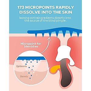 TKTK Self-Dissolving Microdart Acne Pimple Patches for Zits and Blemishes with 100% Pure Hyaluronic Acid, 4 Sizes Acne Absorbing Cover Patch, Acne Spot Treatment Stickers for Face and Skin (99 Count)