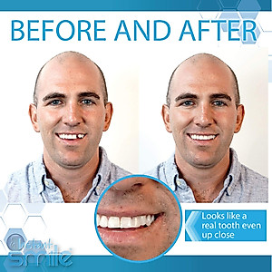 Instant Smile Complete Your Smile Tooth Replacement Kit with 3 Pack Fitting Beads