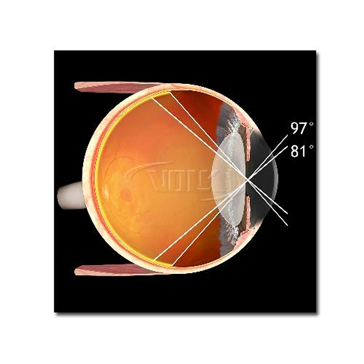 Volk Optical 78D Indirect Ophthalmic Slit Lamp Lens – Blue
