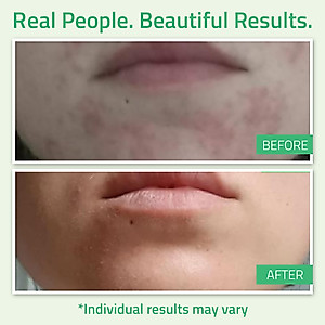 YEOUTH Glycolic Acid Peel for Face, At Home Exfoliator Aha 30% Glycolic Acid Face Peel with Retinol, Designed to Refresh & Smooth the Appearance of Skin 1oz