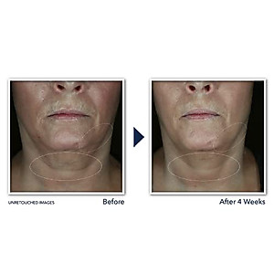 RoC Derm Correxion Neck Cream with Hyaluronic Acid and Advanced Retinol to visibly Tighten & Lift Horizontal Neck Lines, Facial Moisturiser to Contour Face, Neck and Jawline, 1.7oz