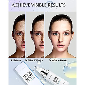 EnaSkin Professional Dark Spot Remover for Face and Body, Perfecting Dark Spot Corrector Serum Treatment, Melasma, Freckle, Sun Spot, Hyperpigmentation, Blemish Spot, Brown Spots for Men&Women, Advanced Formula with Safe Ingredients 4-Butylresorcinol, Koj