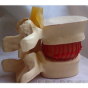 New 2pcs Anatomical Human Lumbar Vertebrae Degenerative Lumbar disc herniation demonstration model Human spine Sold by East Dental