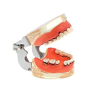 Dental Teeth Typodonts Model for Parodontopathy Periodontal Disease, Removable Gingivae Pathology Teeth Model Used in Teaching,Explain,Studying for Adult(Transparent)
