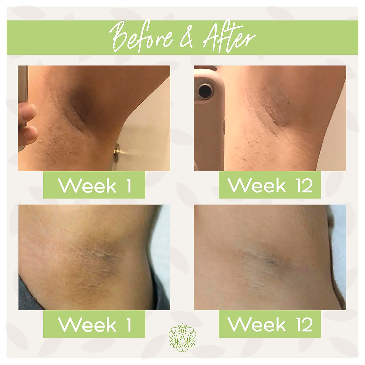 Amaira SOS Intensive Skin Lightening Cream - Natural Brightening Cream and Dark Spot Remover for Body - for Face, Underarms, Knees, Elbows, Dark Spots (1.7 fl oz)