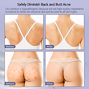 Tobcharm Back Acne Treatment, Butt Acne Clearing Treatment, Body Acne Treatment with Azelaic Acid 3.4 fl. oz., Great for Men and Women Acne Scar Treatment, Hormonal Acne And Cystic Acne Treatment