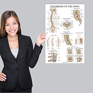 Palace Learning Disorders of the Spine Anatomy Poster - Laminated Spinal Disorders Anatomical Chart - 18" x 24"