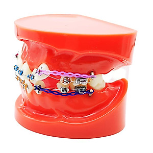 Dental Typodont With Metal Brackets Orthodontic Teeth Model With Ligature Ties Red