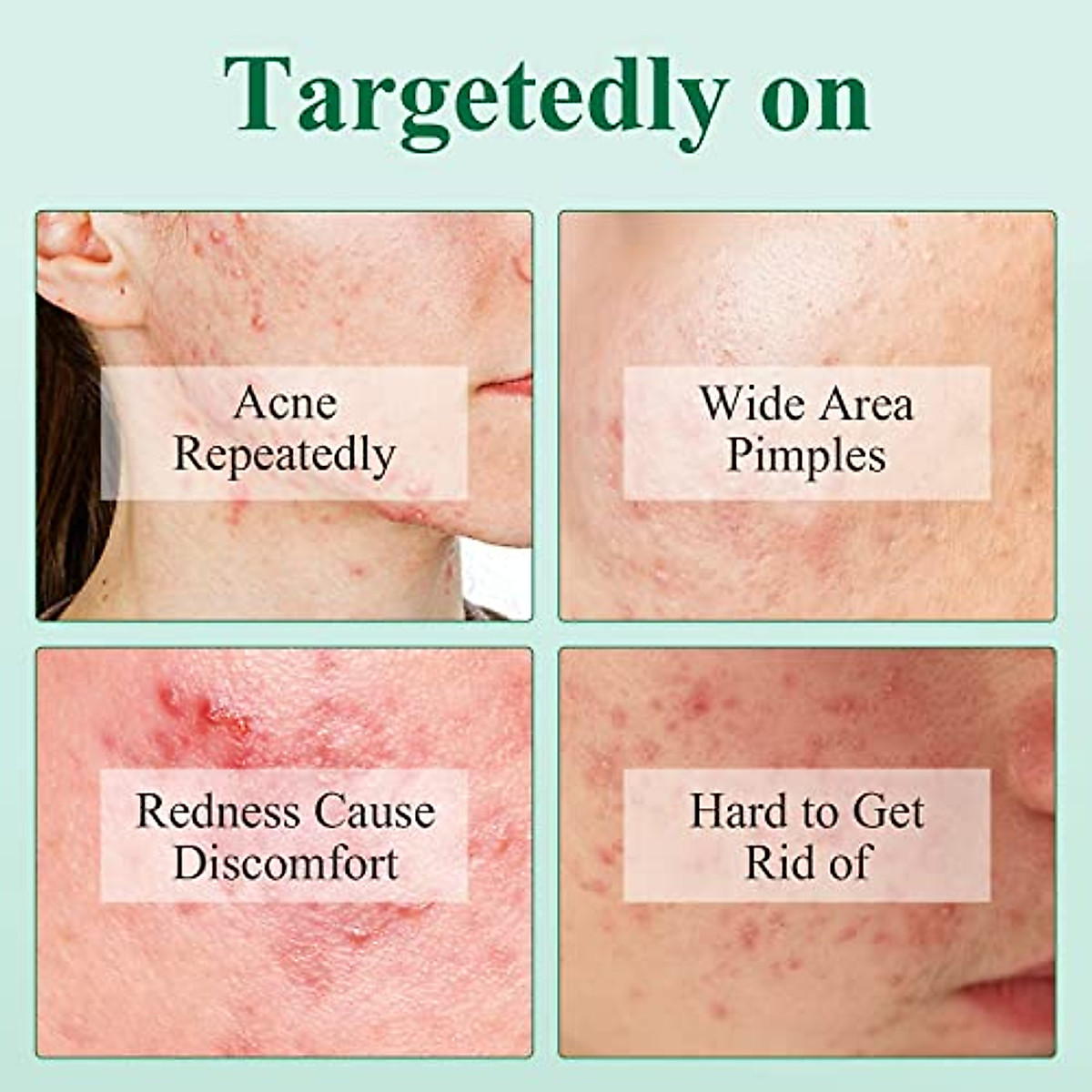 Acne Treatment Kit, Tea Tree Oil Serum & Cream,Skin Care Set for Prone Face Sensitive, Cystic Acne Pimples Scars Remover, Redness Relief, Niacinamide Facial Moisturizer, Anti Aging, Daily Prevention