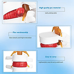 faruijie Disc Herniation Model - 1.5X Lumbar Herniated Disc Model Vertebral Spine Anatomical Medical Model