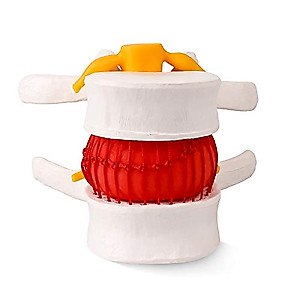MIIRR Human Lumbar Disc Herniation Model, Vertebral Spine Anatomical Medical Model Perfect for Learning & Teaching Tool - Lumbar Vertebral Spine Model
