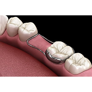 Space Maintainer For Children,10 Size/Box, 40pcs/Box, 4pcs/Size From Sino Dental Group (#6 Molar)