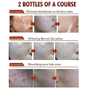 BIOAQUA Acne Scar Natural Blemish Gel Acne Pimple Acne Spot Removal Cream, Oil Control Shrink Pores Face Care Cream