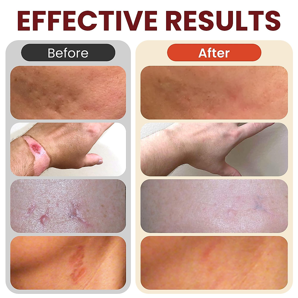 e70 Intensive Healing Scar Cream - Fast Repair Surgical Scars, C-Section, Stretch Marks, Keloids, Burns, Old & New Scars. Vitamins Full - All Skin Types - Reduce Acne Spots Appearance - 2.0 Fl Oz