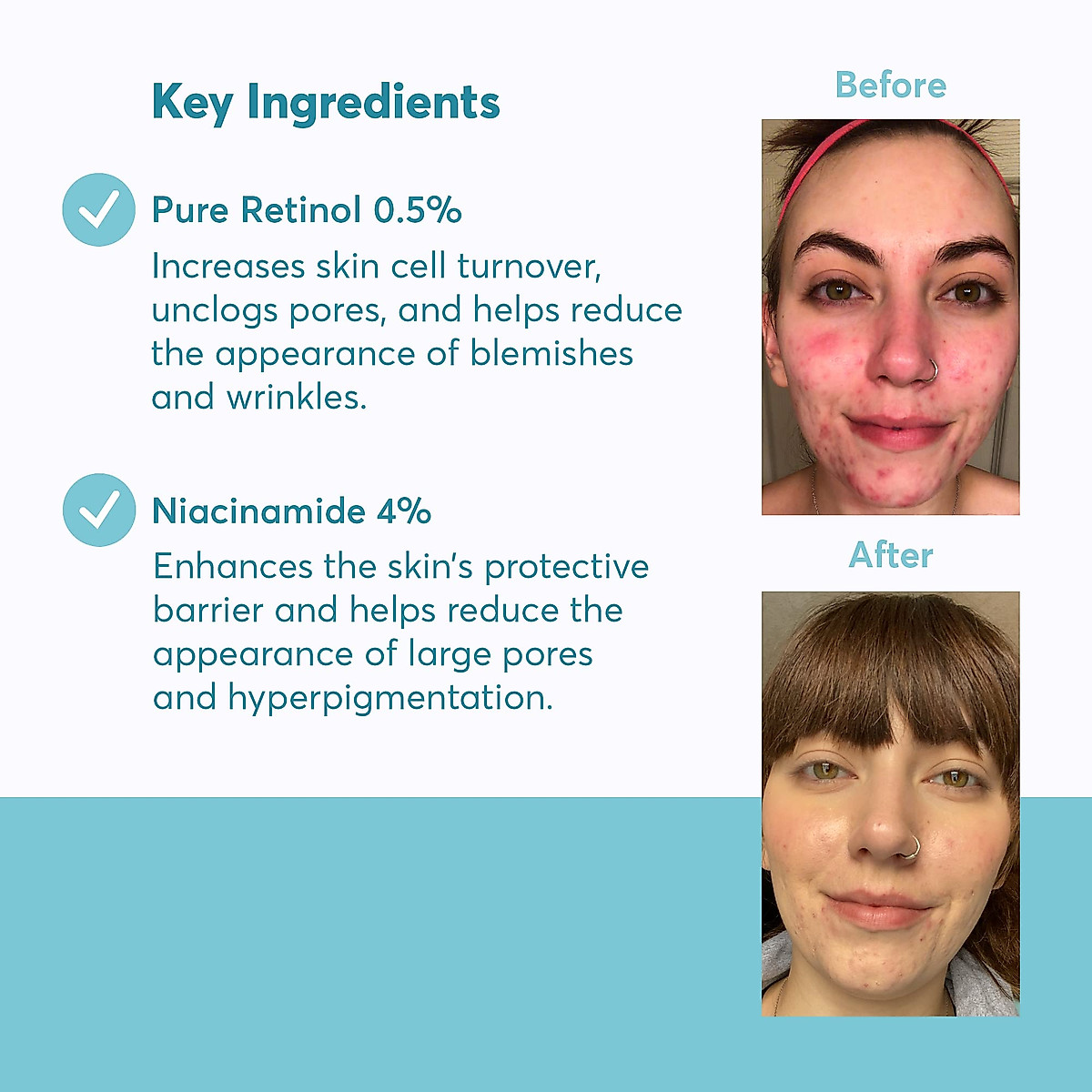 MDacne – Retinol 0.5% and Niacinamide 4% Cream, Reduces Blemishes and Improves Skin Texture without Irritation