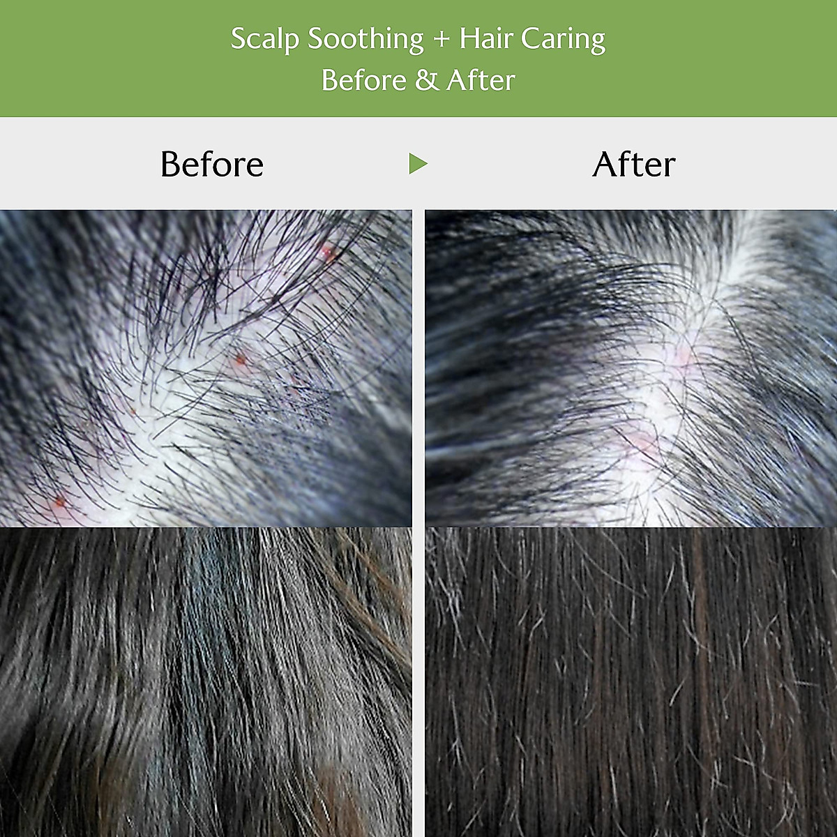 LA'DOR Hair Conditioner - Tea Tree Scalp Clinic Hair Pack, 6.76 Fl Oz - Calming & Nourishing with Snail Mucin, Green Tea, Aloe for Itchy Sensitive Dry Flaky Damaged Scalp