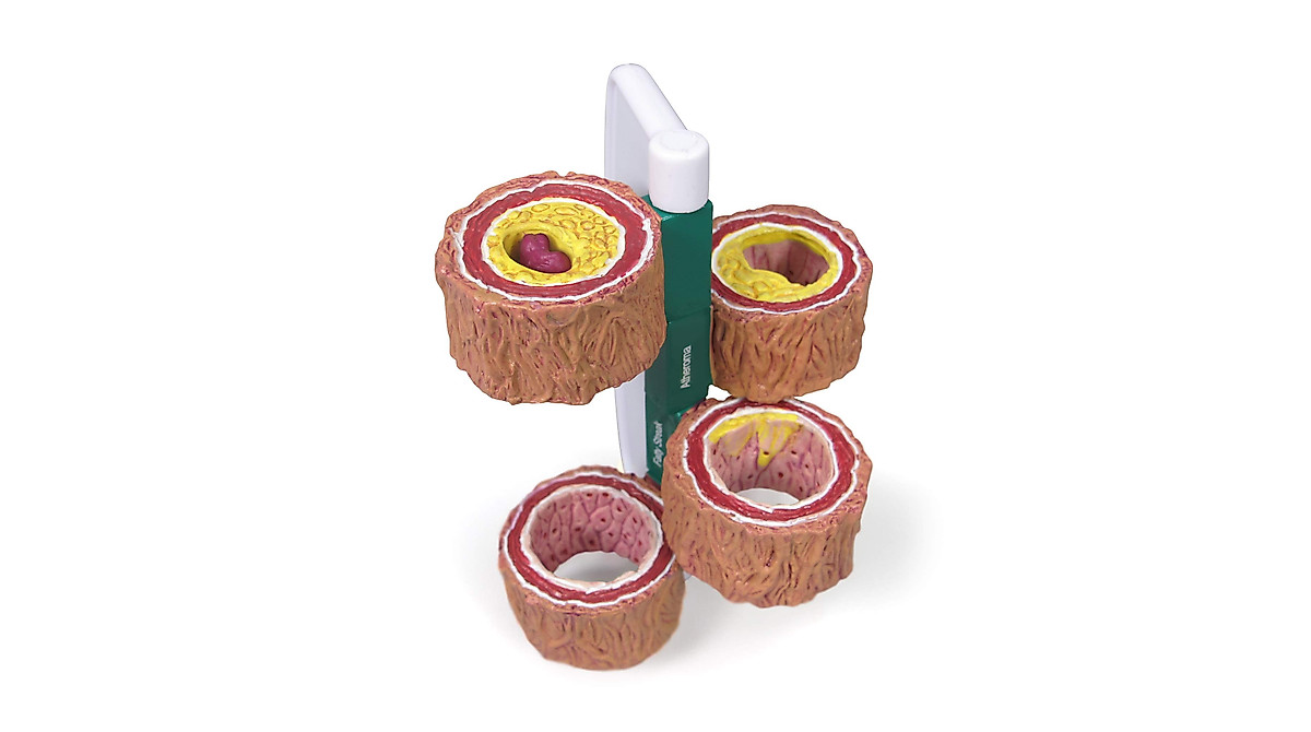 4-Piece Artery Model for Atherosclerosis Education | GPI Anatomicals