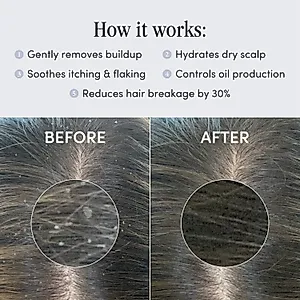 Jupiter Dandruff Shampoo with Serum Duo, Relieves Itchy, Dry, Flaky Scalp, Color-Safe, & Sulfate-Free, Vegan, Both with Zinc, Vitamin B5, Green Tea, Spot Treatment with Niacinamide & Aloe Vera