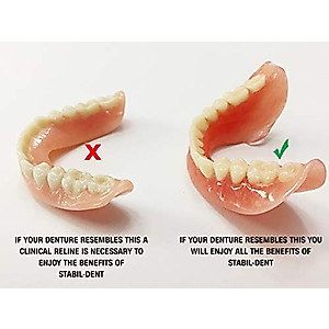 Lower Denture Stabilizers
