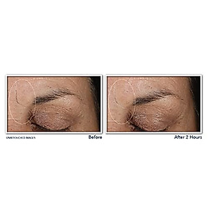 RoC Retinol Correxion Deep Wrinkle Non-Invasive Targeted Patches with Hyaluronic Acid + Firming Peptides for Forehead and Between Eyes, 3 Pouches of 2 Patches Each + 1 Packette of Eye Cream
