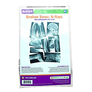 Roylco Broken Bones X-Rays – 15 Realistic Fracture Images for STEM/STEAM Learning, Classroom Anatomy, Health Education, and Labs – Perfect for Teachers, Parents, and Medical Training