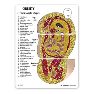 Obesity Model | Human Body Anatomy Replica of Overweight Body Types for Doctors Office Educational Tool | GPI Anatomicals