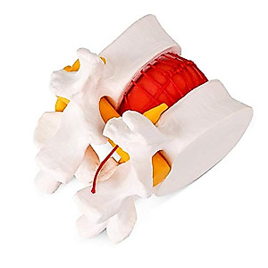 MIIRR Human Lumbar Disc Herniation Model, Vertebral Spine Anatomical Medical Model Perfect for Learning & Teaching Tool - Lumbar Vertebral Spine Model