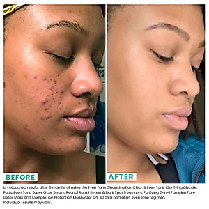 Clear & Even Tone Clarifying Glycolic Pads | Urban Skin Rx® | Powerful Formula Targets Blemishes, Removes Excess Oil and Evens Skin Tone, Formulated with Glycolic, Salicylic and Lactic Acids | 30 Pads