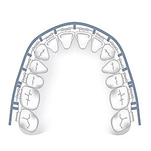 Comfort Cover for Braces, Lip Protector Mouth Guard Lip Cushion Teeth Shield Bumper for Brackets, Aligner, Dental Wax Alternative, Hard and Rigid Clip