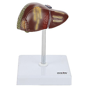 Axis Scientific Anatomy Model of Diseased Liver | Model is 1/3 Life-Size and Divides in 2 Parts | Shows 6 Liver Diseases and Abnormalities | Comes on a White Base