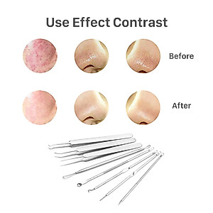 Pinkiou Blackhead Removers Comedone Pimple Popper Tool Acne Extractors Blemish Remover Ingrown Hair Tweezers Removal Kit Whitehead Remover Zit Treatment Skincare Tools for Face Nose, 8-in-1