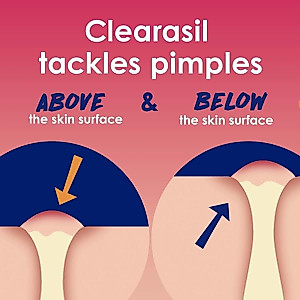 Clearasil Rapid Rescue Deep Treatment Wash, 6.78 Fl Oz (Packaging May Vary) (Pack of 4)