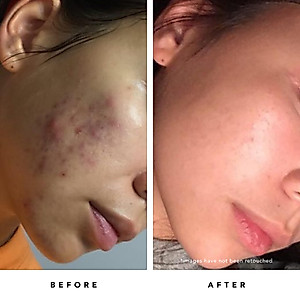 HERBIVORE Blue Tansy BHA & Enzyme Pore Refining Mask - Naturally Clarifies Acne, Blemishes & Redness, Vegan & Cruelty-Free, 60 mL / 2.02 oz