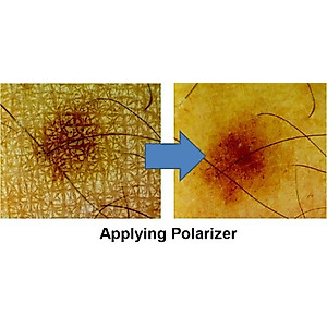 Firefly DE350 Wireless Polarizing Dermatoscope