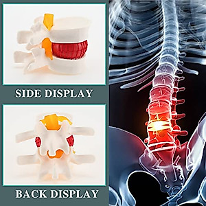 RONTEN Lumbar Disc Herniated Model, Human Anatomical Lumbar Spine Model for Medical Teaching & Learning