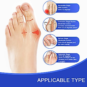 Toe Corrector Toe Separator Bunion Splint 【2024 Updated】 Hallux Valgus Bunion Big Toes Corrector Set Bunion Brace Bunion Exercise Strap Orthopedic Kit Bunion Pain Relief (free, Blue)