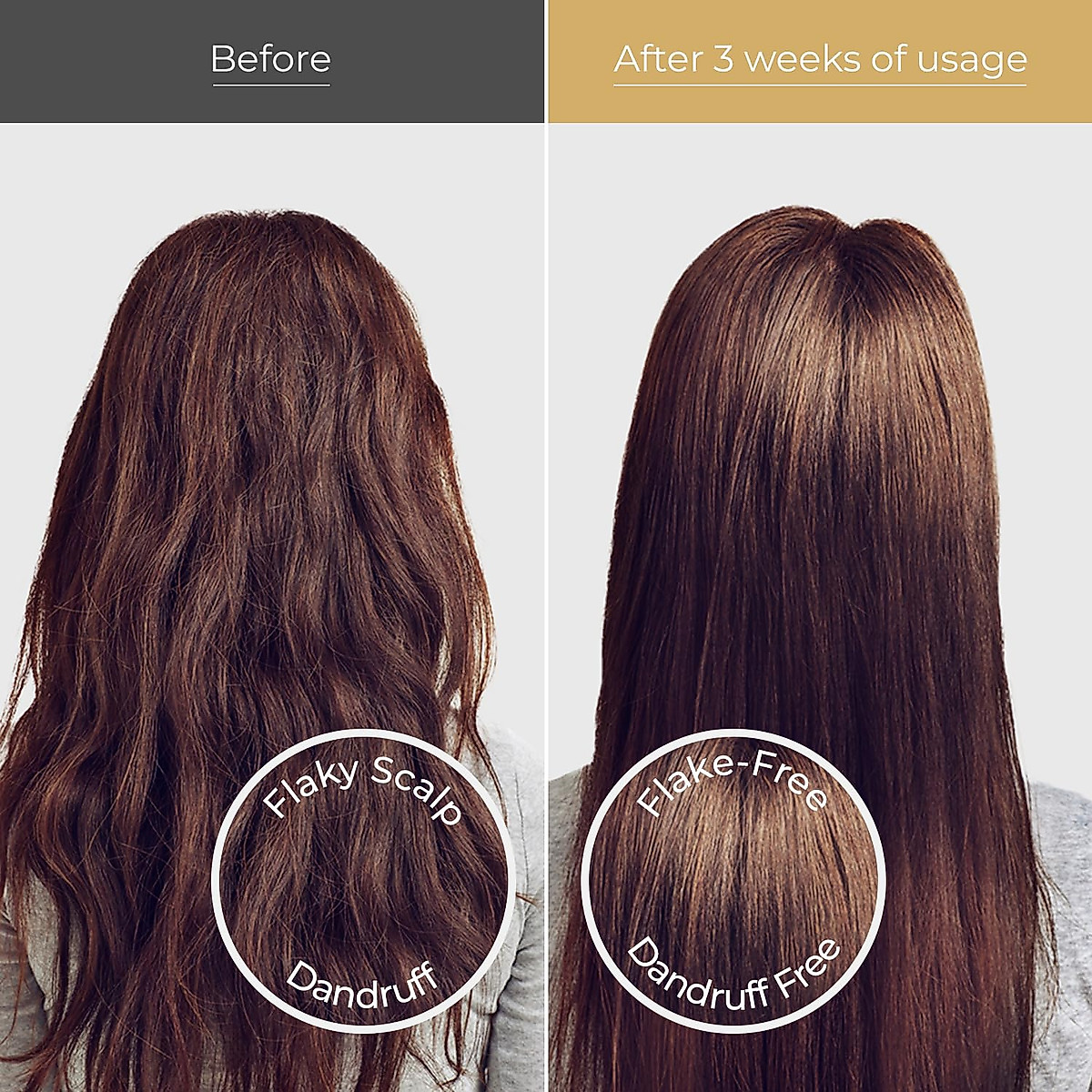 Anti Dandruff Shampoo - Sulfate-Free, Dry Scalp Soothing, Itchy Scalp Relief, Tea Tree Oil & Apple Cider Vinegar, Paraben Free Shampoo - Best Shampoo for Dandruff, Flakes, Itching & Scalp Care