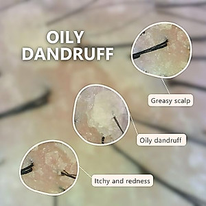 Aromase Oily Balancing Shampoo (Ideal for oily scalp with dandruff) 14 FL OZ