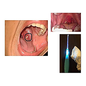 Melleco Upgraded 6.75" Tonsillith Pick Tonsil Stone Remover Tool Care, Blue + Cleaning Irrigator Syringe + Stainless Steel Pick + Throat Nose Nasal Mist Pump Bottle