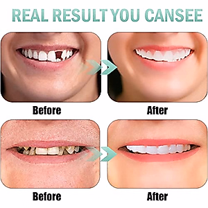 Denture Teeth Temporary Fake TeethSnap On Veneers, Snap in for Men and Women,Cover The Imperfect Teeth,No Pain No Shot Drilling,Fix Confident Smile(2 Pcs)-BB01