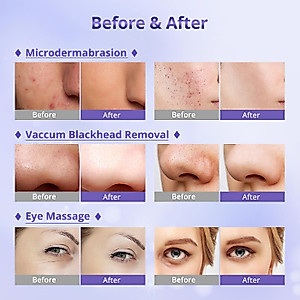 UNOISETION Microdermabrasion Machine Professional 3 in 1 Diamond Microdermabrasion Machine for Facial Skin Care Home Diamond Dermabrasion Machine with Eye Massager & 9 Microdermabrasion Tips