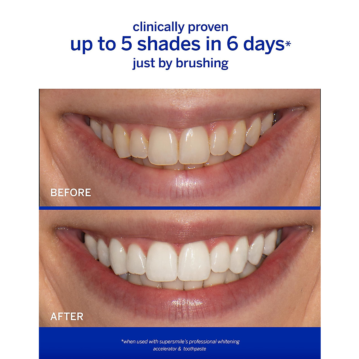 Supersmile Professional Whitening Accelerator - Powerful Whitening without Sensitivity - Safe and Effective on Dental Restorations (3.6 Oz)