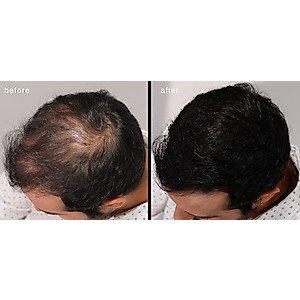 LUXE Hair Thickening Fibers - CONFIDENCE IN A JAR – 2 Months+ Supply! – Hypoallergenic, Dermatologist Tested – Multiple Colors Available (Dark Brown)