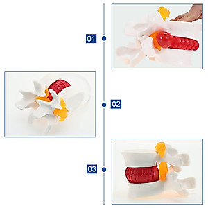 ASINTOD Human Anatomy Lumbar Disc Herniation Model,A Model Showing The Anatomy of Human Lumbar Disc, An Excellent Choice for Teaching and Learning The Human Lumbar Spine