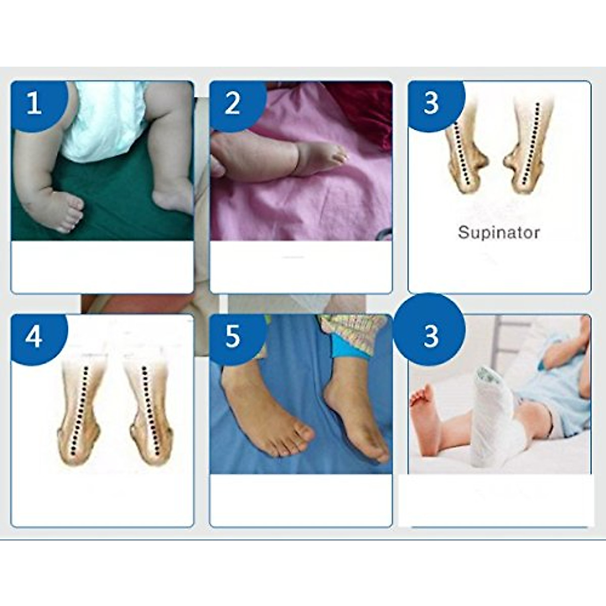 Kids AFO Drop Foot Splint Baby Ankle Foot Brace Night Splint Toddler Strephenopodia Strephexopodia Splint (20cm)