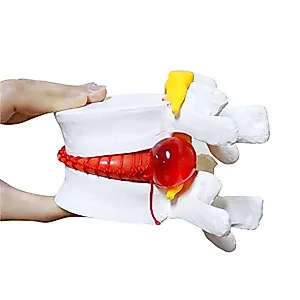 Global-Dental Anatomical Herniated Lumbar Vertebrae Disc Prolapse Model Human Anatomy Model White