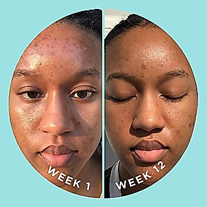 ZitSticka Vitamin Acne Supplement for Cystic Acne w/ 30 Natural Caps for Women and Men, Supplements for Hormonal Support, Skin Clarity, Dark Spots - Dermatologist Tested (Blur Potion™)