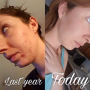 Ninja Skincare 10% Benzoyl Peroxide Medication Wipe out Wash For Acne Paraben-Free: The Strongest Topical Treatment for Clearer Skin